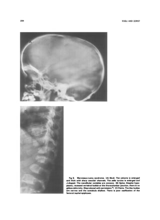 The Mucopolysaccharidoses and Related conditions | PDF