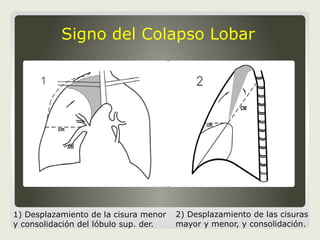 Signos Radiologicos De Torax Ppt