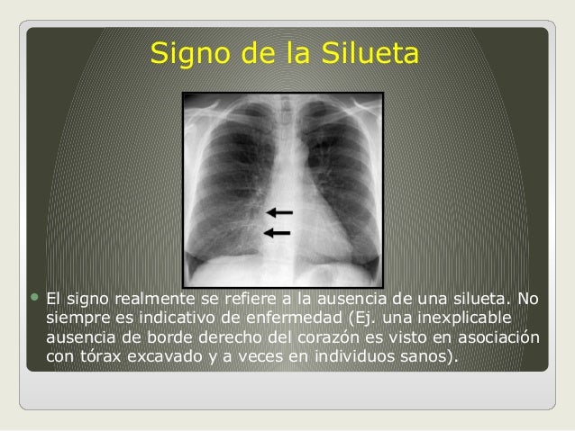 Signos radiologicos de Torax