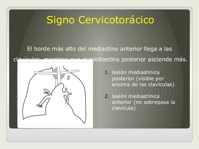 Signos radiologicos de Torax