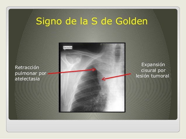 Signos radiologicos de Torax