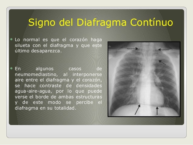 Signos radiologicos de Torax