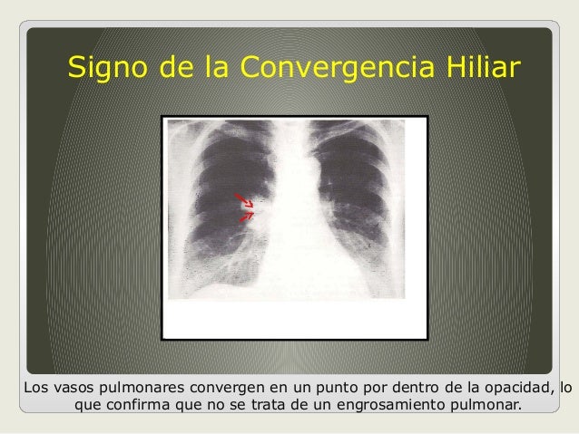 Signos radiologicos de Torax