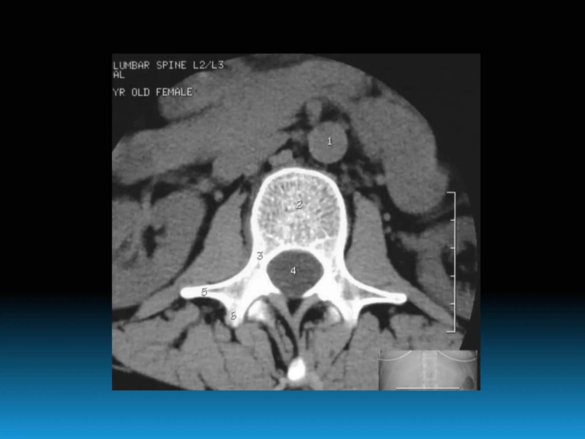1- spine and brase techniques has specific indications, procedures, and ...
