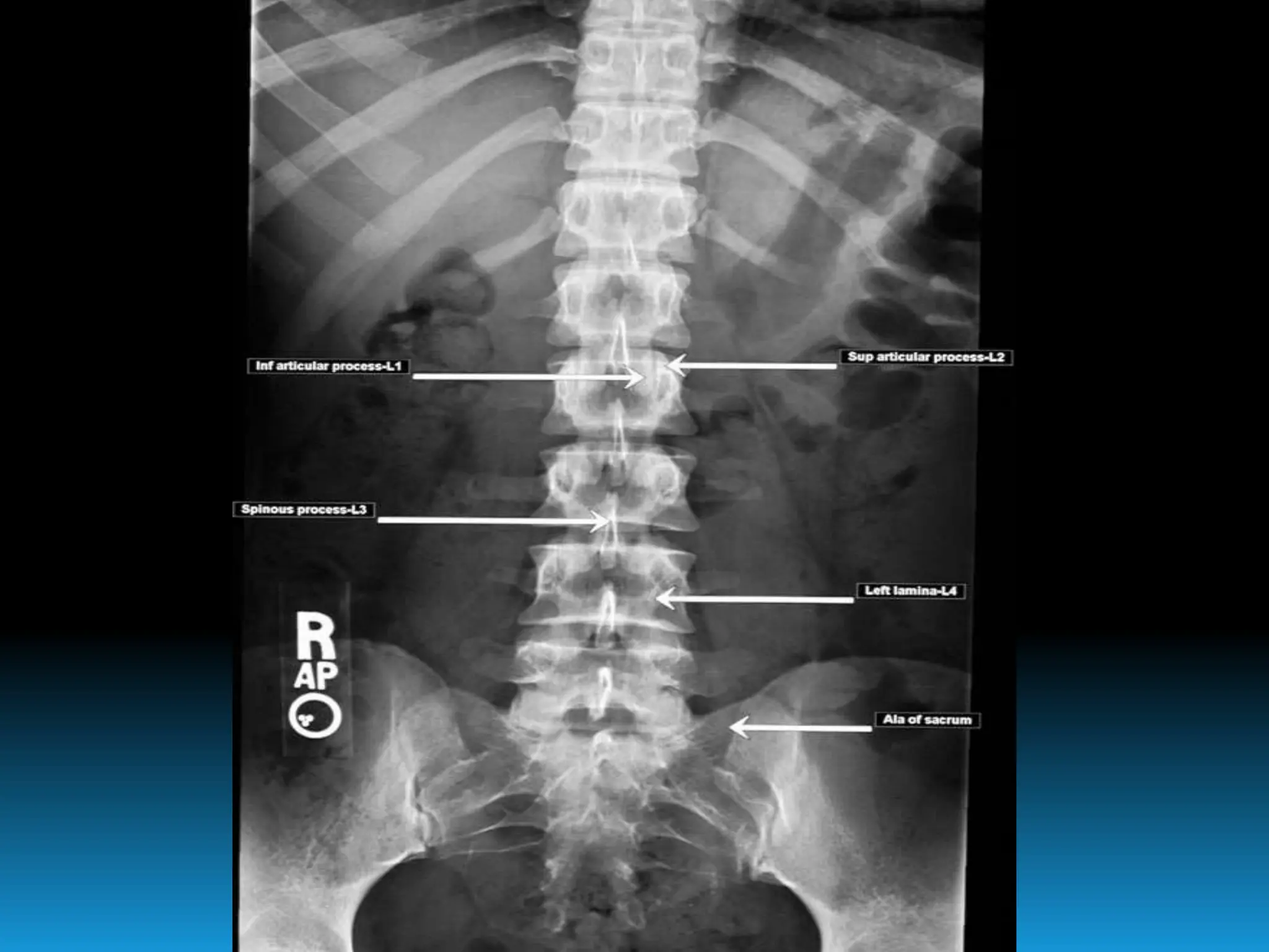 1- spine and brase techniques has specific indications, procedures, and ...