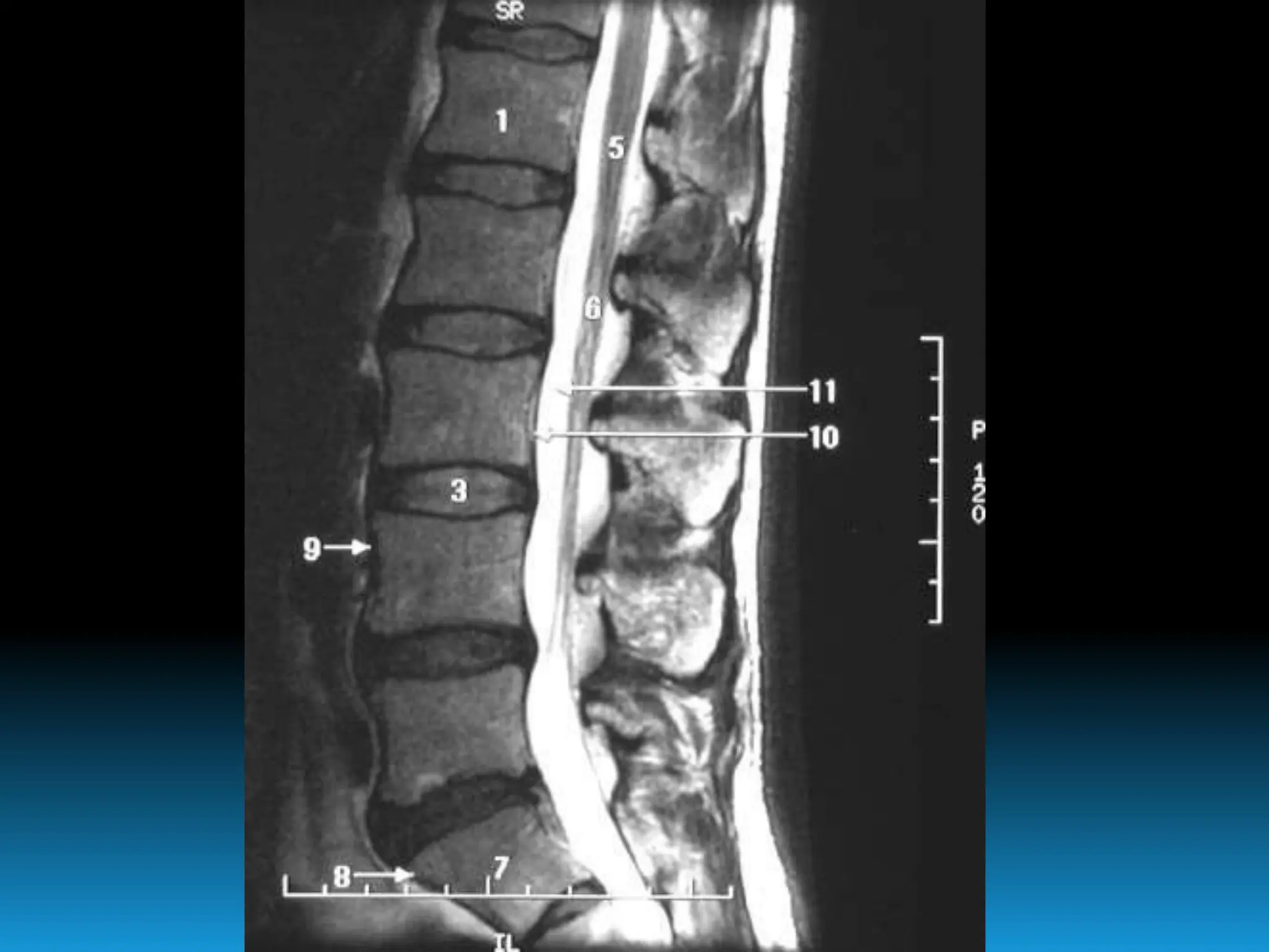 1- spine and brase techniques has specific indications, procedures, and ...