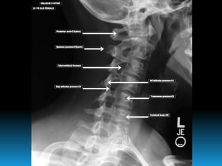 1- spine and brase techniques has specific indications, procedures, and ...