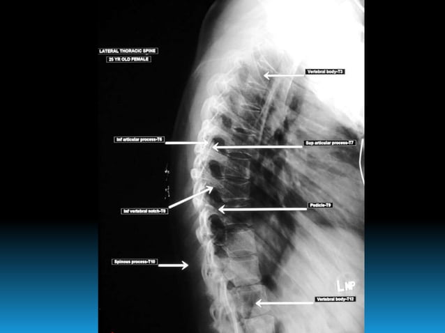 1- spine and brase techniques has specific indications, procedures, and ...