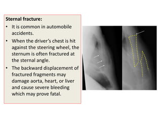 1-Sternum-Osteology- 1 & 2.pdf