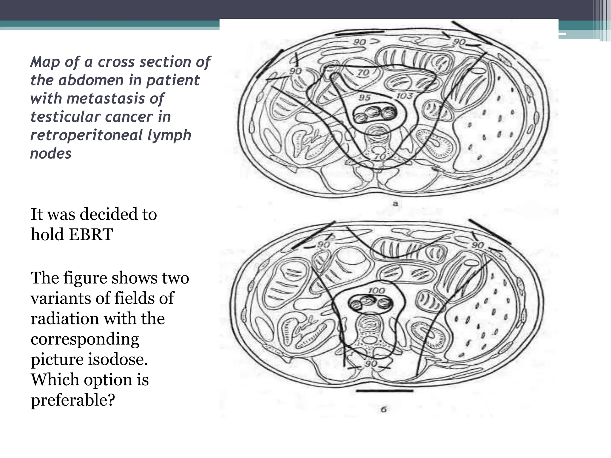 Radiotherapy ppt. Types of radiation and chronic | PPTX