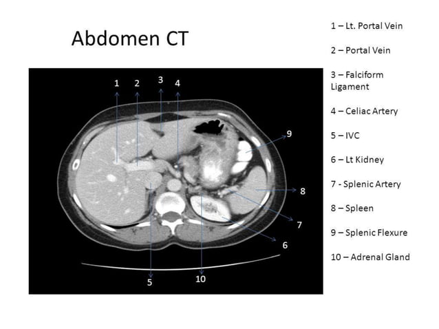 1- Surgical Anatomy of the Retroperitoneal & Pelvic Extraperitoneal Space