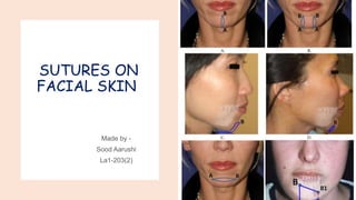 1 - Sutures on facial skin presentation.pptx