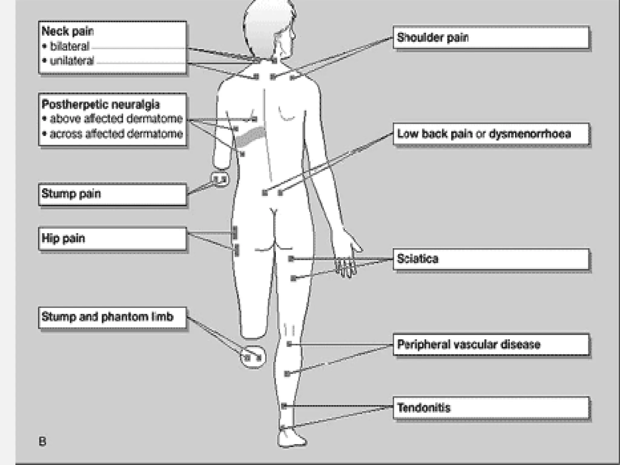 TENS Trans cutaneous electrical nerves stimulation | PPT | Physical ...