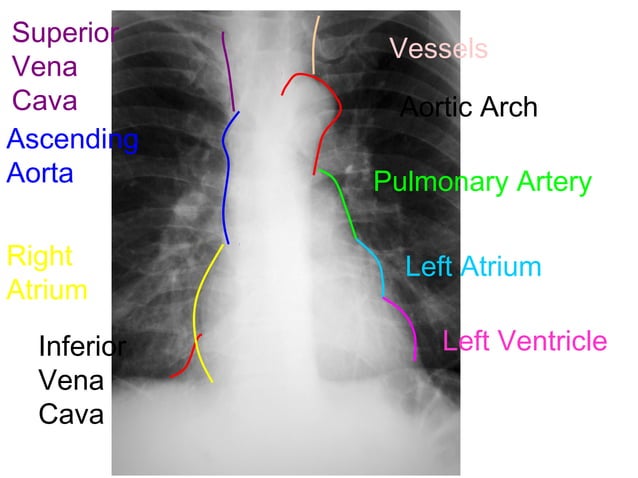 1 the normal cxr | PPT