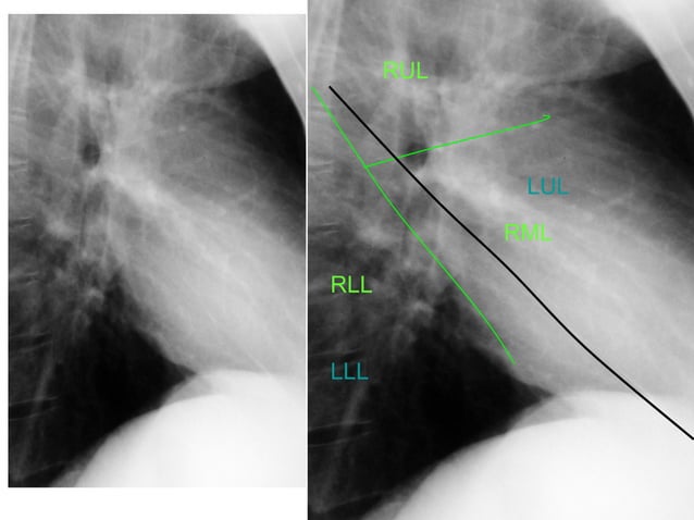 1 the normal cxr | PPT