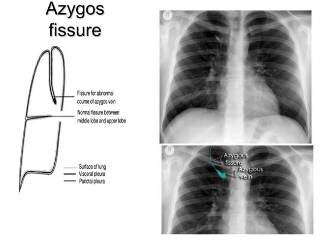 1 the normal cxr | PPT | Free Download