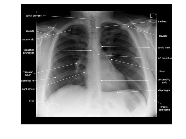 1 the normal cxr | PPT | Free Download