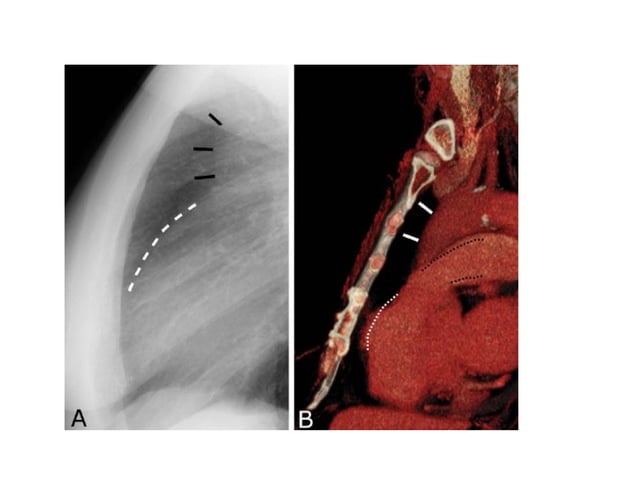 1 the normal cxr | PPT