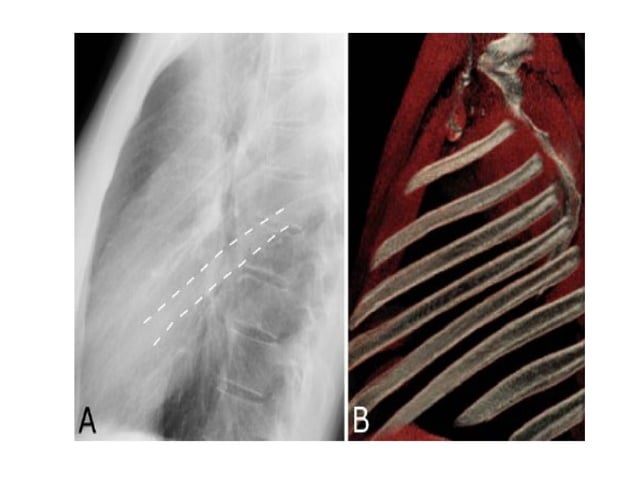 1 the normal cxr | PPT