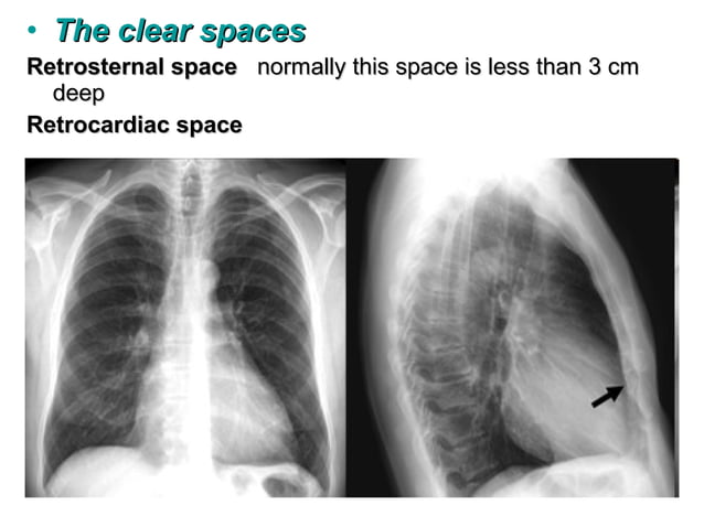 1 the normal cxr | PPT