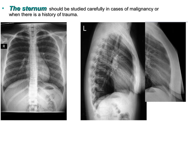 1 the normal cxr | PPT