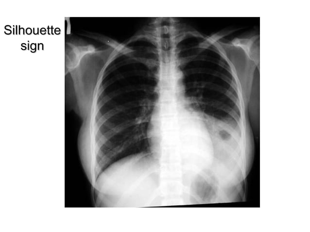 1 the normal cxr | PPT