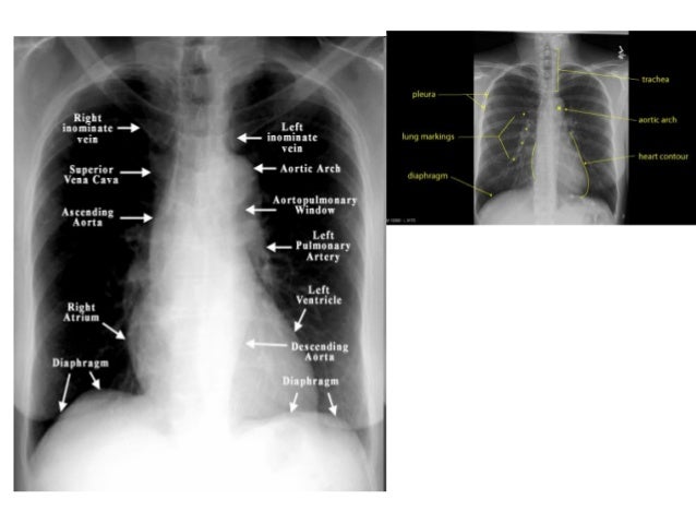 1 the normal cxr