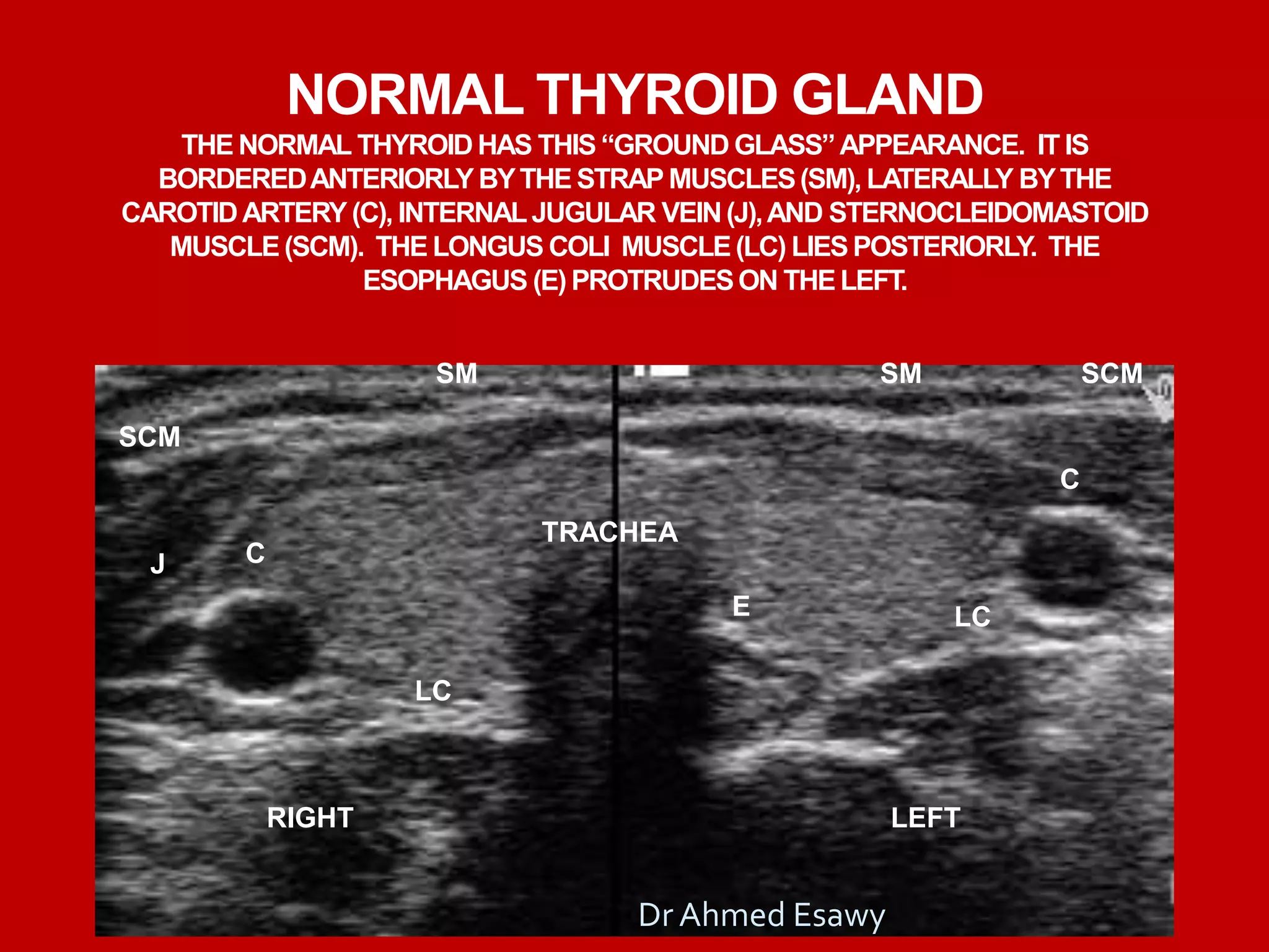 thyriod gland imaging part 1 (radiological anatomy differential ...