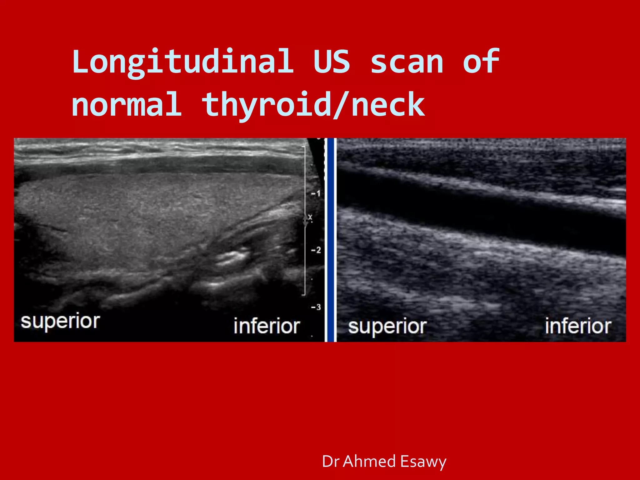 thyriod gland imaging part 1 (radiological anatomy differential ...