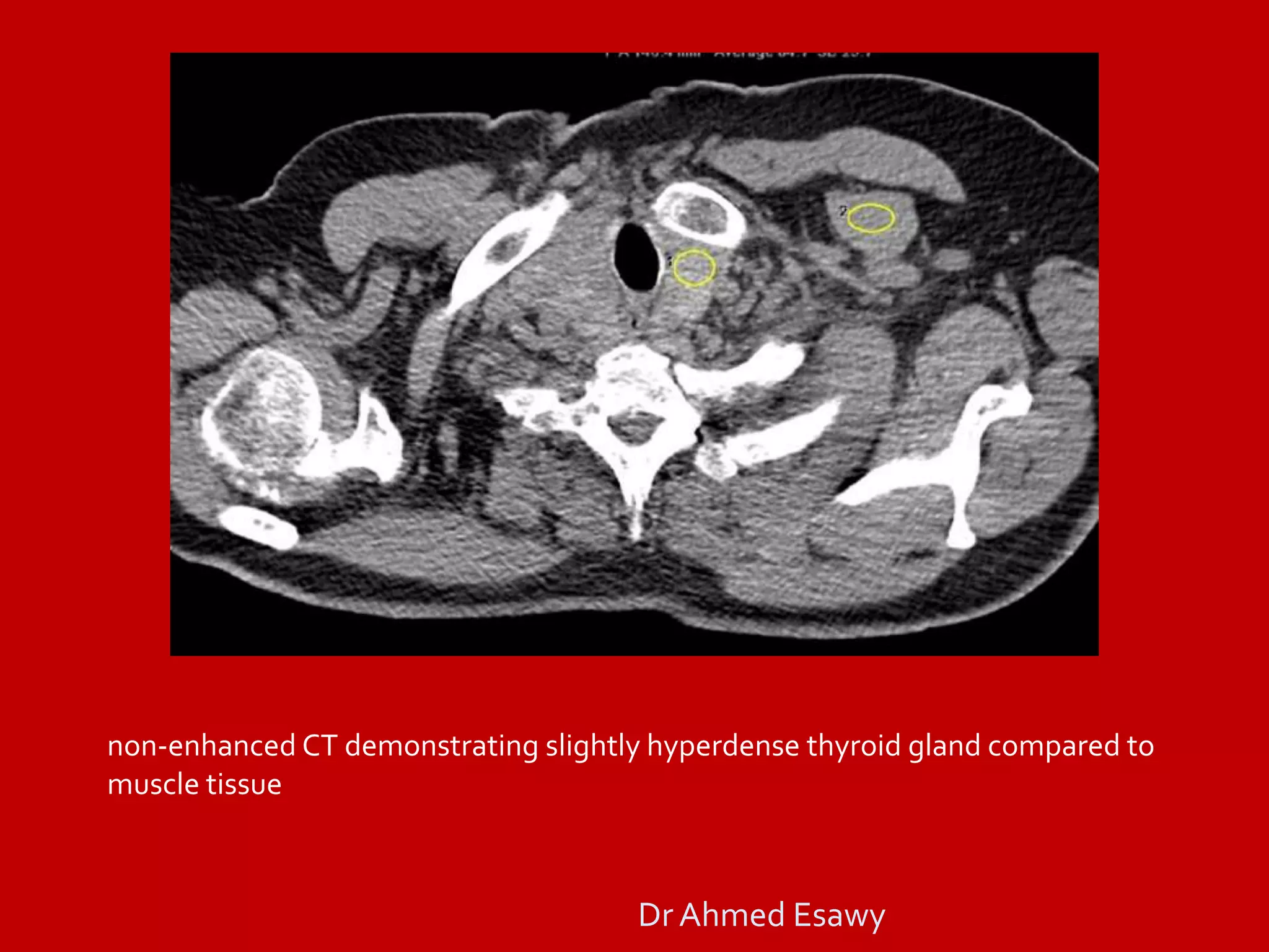 thyriod gland imaging part 1 (radiological anatomy differential ...