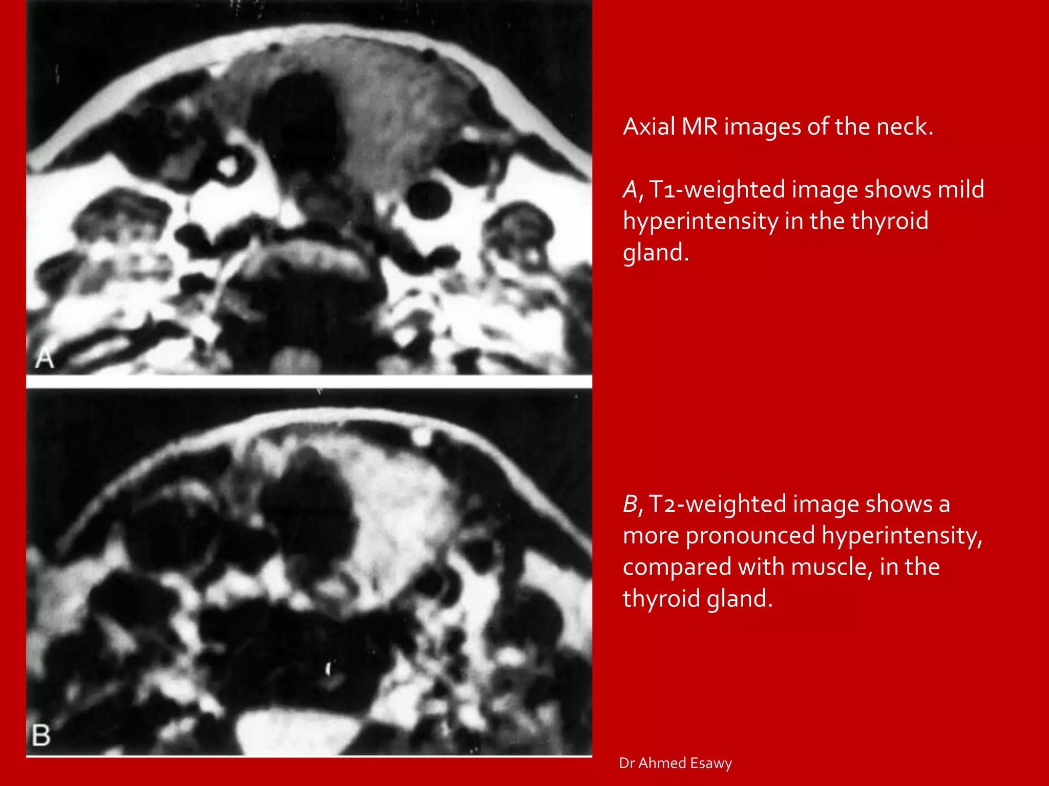 thyriod gland imaging part 1 (radiological anatomy differential ...