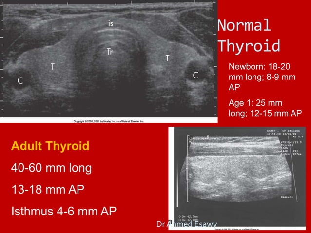 thyriod gland imaging part 1 (radiological anatomy differential ...