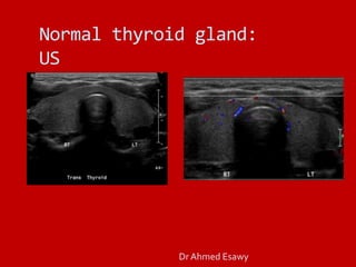 Normal Thyroid Gland