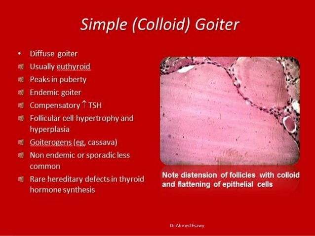 Nontoxic Uninodular Goiter