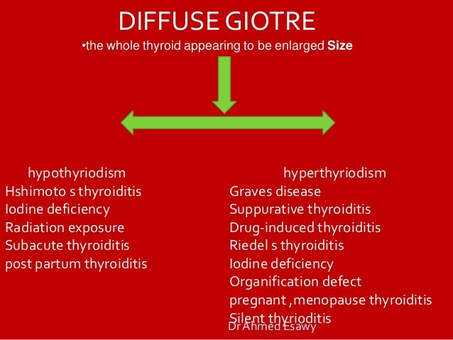 Nontoxic Uninodular Goiter
