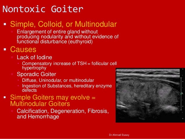 Nontoxic Uninodular Goiter