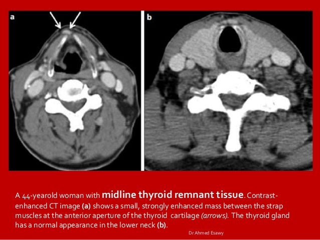 thyriod gland imaging part 1 (radiological anatomy differential diagn…