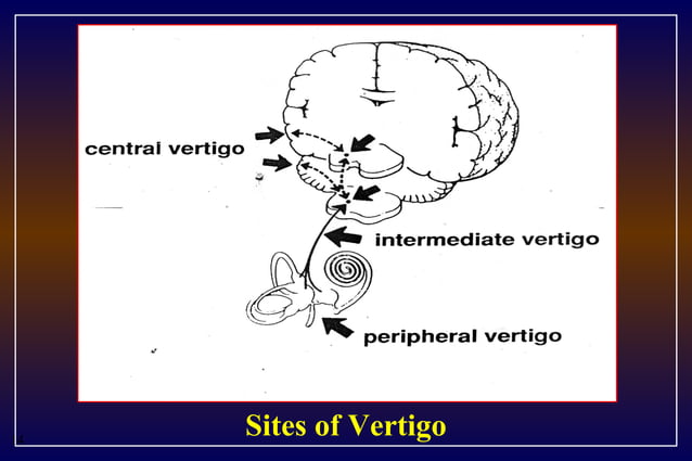 1 vertigo imbalance , balance disorders | PPT | Brain and Nervous ...