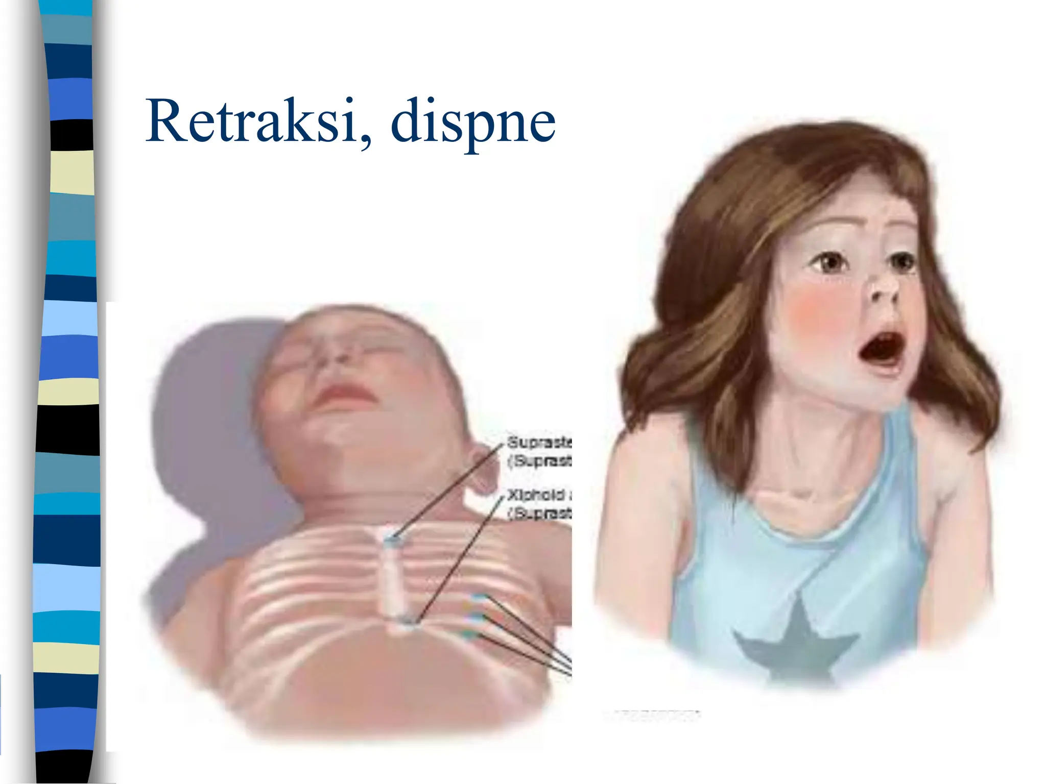 10-01 Tatalaksana anak dg ggn respiratori 1.ppt