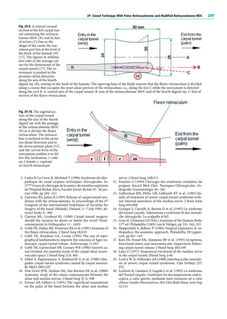 Carpal tunnel syndrome: release with MDC retinaculotome | PDF