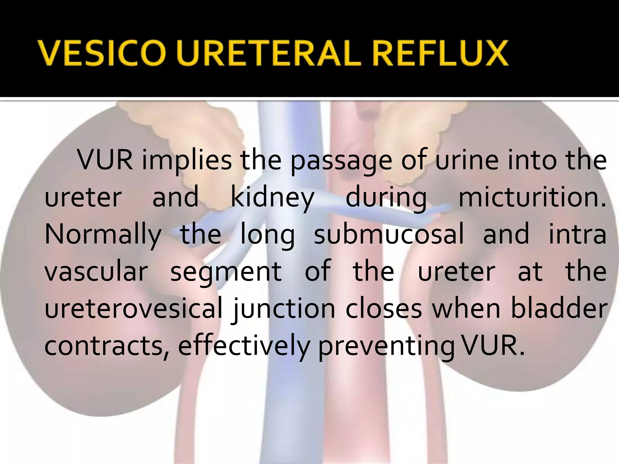 vesicourethral reflux | PPTX