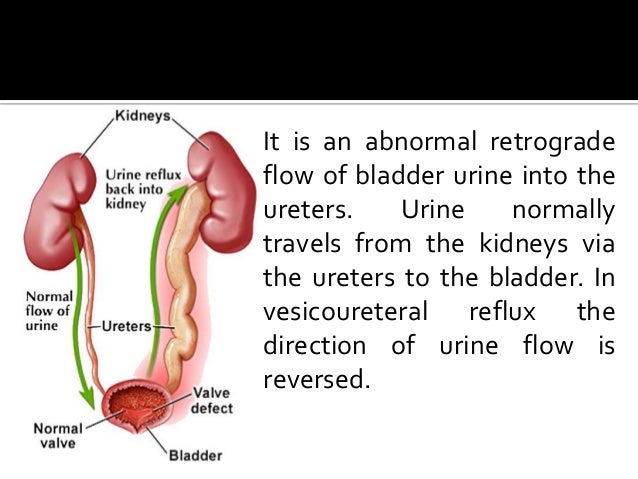 vesicourethral reflux