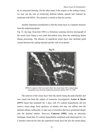 smear layer in endodontics/ rotary endodontic courses by indian dental ...