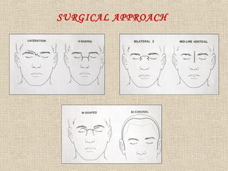 . nasoethmoid complex fractures | PPT
