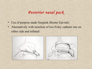 . nasoethmoid complex fractures | PPT
