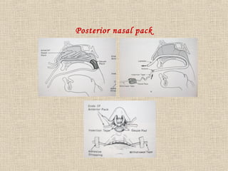 . nasoethmoid complex fractures | PPT