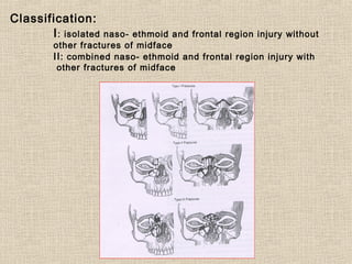 . nasoethmoid complex fractures | PPT