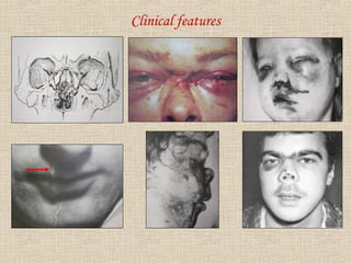 . nasoethmoid complex fractures | PPT