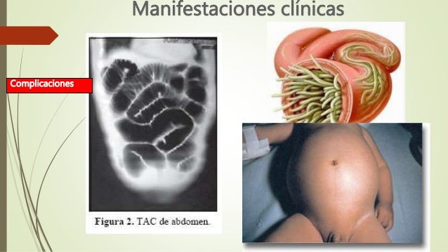 Ascaris Lumbricoides