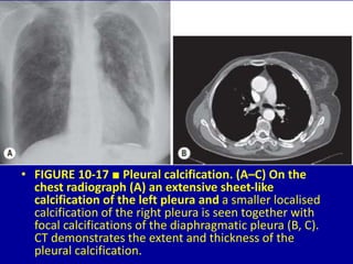 The Chest Wall, Pleura, Diaphragm and Intervention 10 Dr. Muhammad Bin ...